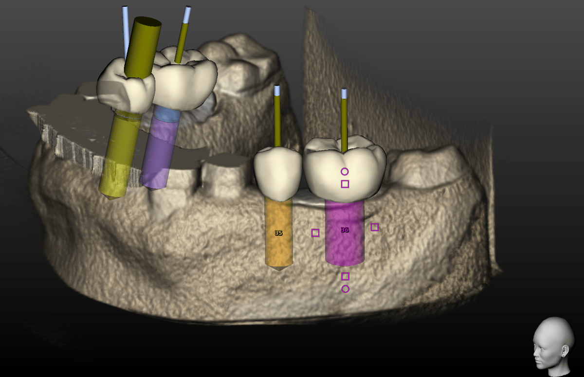 Navident - THE NEXT GENERATION OF DENTAL DYNAMIC NAVIGATION