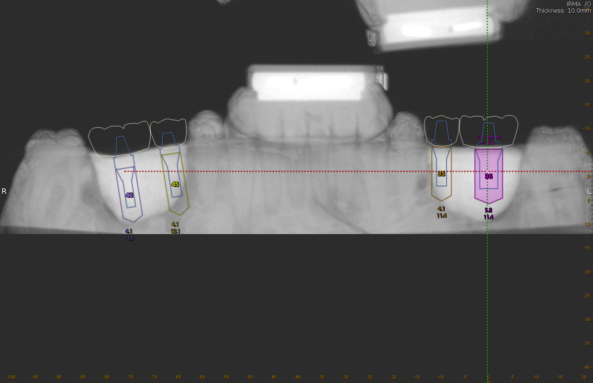 Navident - THE NEXT GENERATION OF DENTAL DYNAMIC NAVIGATION