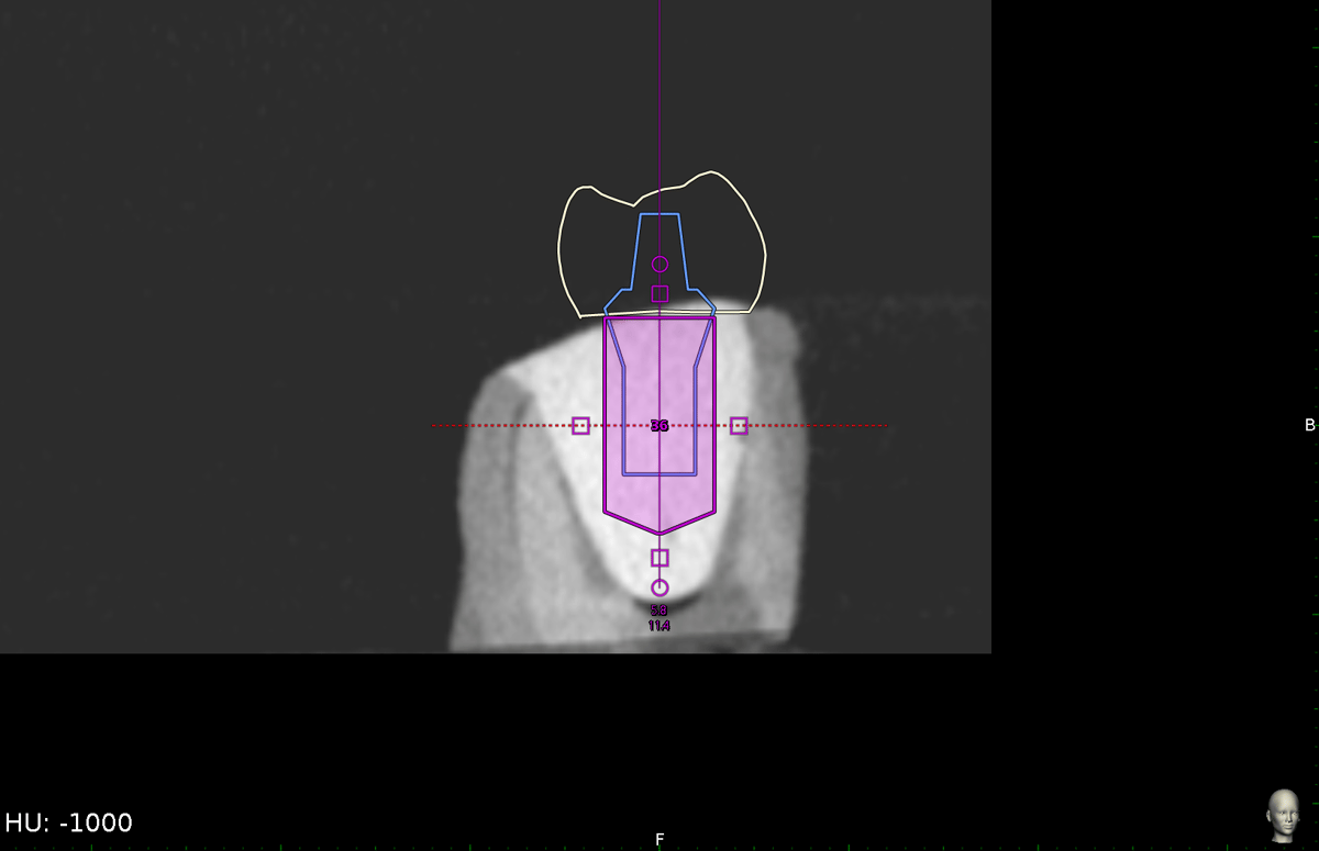 Navident - THE NEXT GENERATION OF DENTAL DYNAMIC NAVIGATION