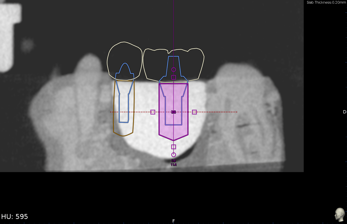 Navident - THE NEXT GENERATION OF DENTAL DYNAMIC NAVIGATION
